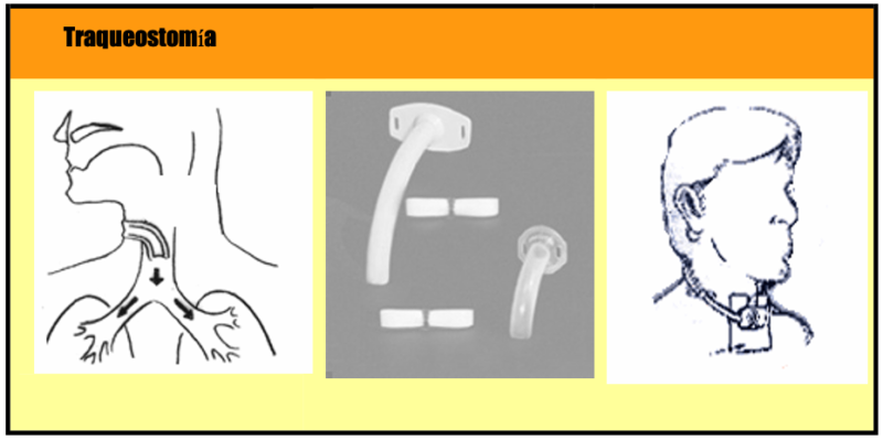 Tratamiento del Cáncer de Cabeza y Cuello - TTCC